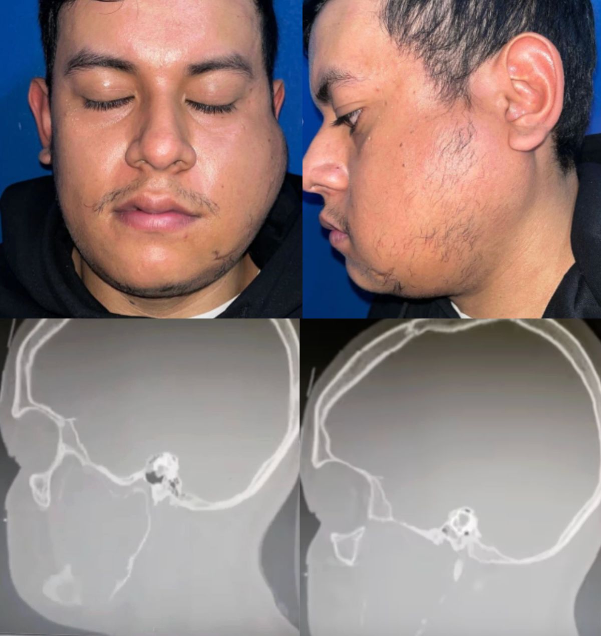 22 Year Old With Ameloblastoma of the Mandible — Smile Back Foundation